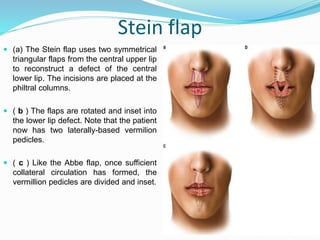 Dr. Rasel lip reconstruction cme DDCH, Dhaka, Bangladesh | PPTX