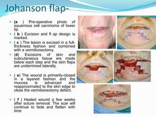 Dr. Rasel lip reconstruction cme DDCH, Dhaka, Bangladesh | PPTX