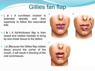 Dr. Rasel lip reconstruction cme DDCH, Dhaka, Bangladesh | PPT