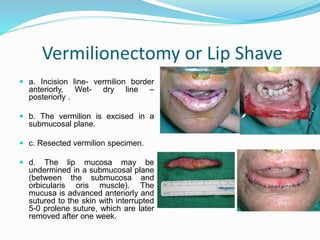 Dr. Rasel lip reconstruction cme DDCH, Dhaka, Bangladesh | PPT