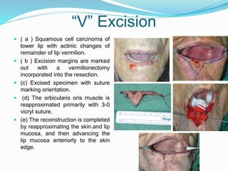 Dr. Rasel lip reconstruction cme DDCH, Dhaka, Bangladesh | PPT