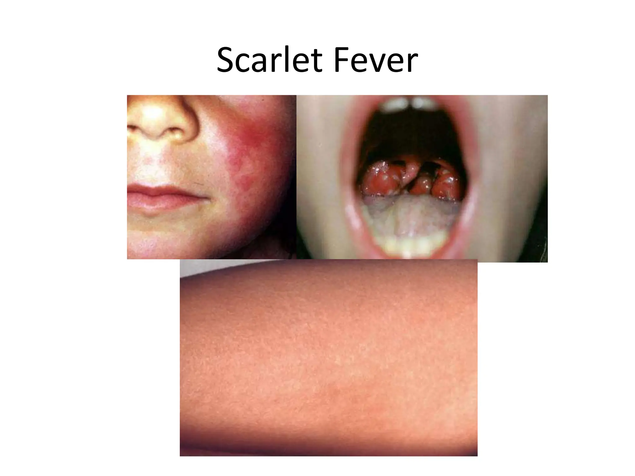 Approach to Common Pediatric Rashes .pptx