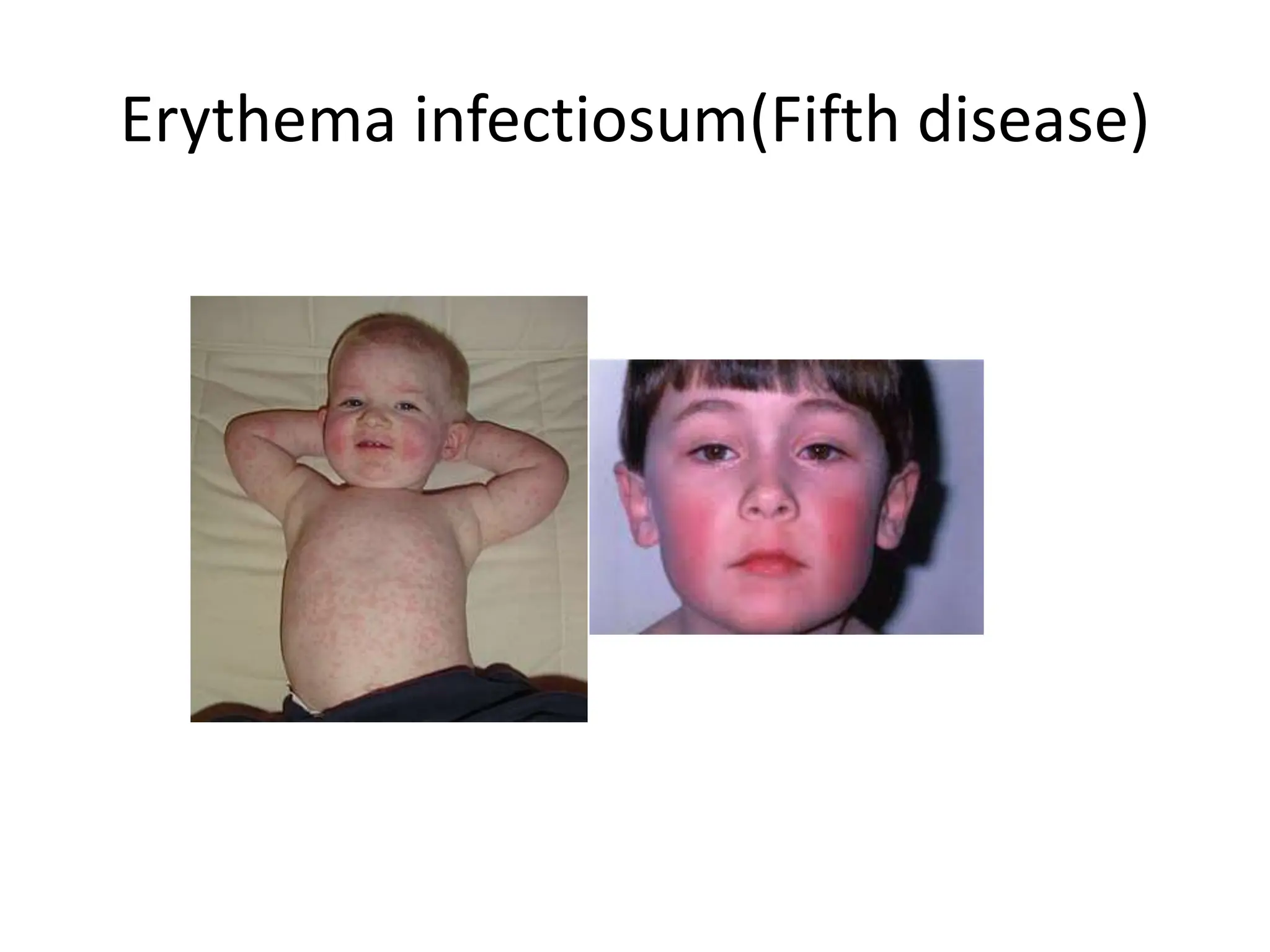 Approach to Common Pediatric Rashes .pptx | Infectious Diseases ...