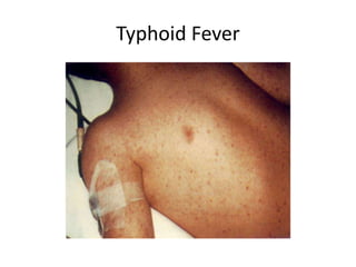 Approach to Common Pediatric Rashes .pptx