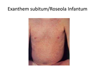 Approach to Common Pediatric Rashes .pptx