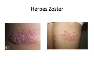 Approach to Common Pediatric Rashes .pptx