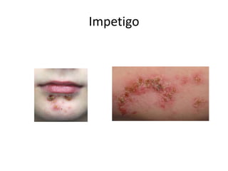 Approach to Common Pediatric Rashes .pptx