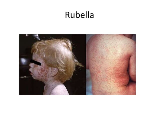 Approach to Common Pediatric Rashes .pptx | Infectious Diseases ...