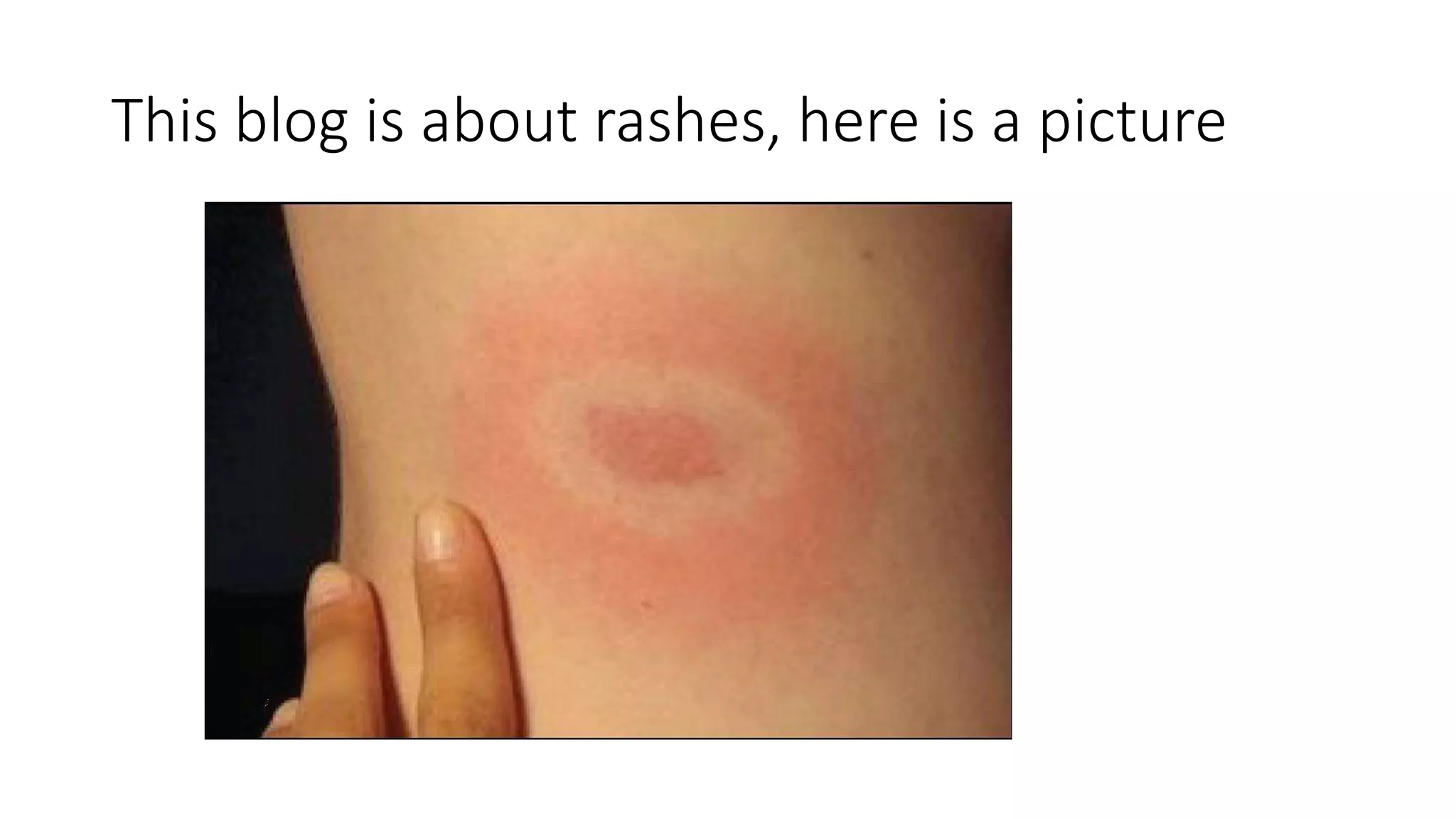 Rashes 101 | PPTX