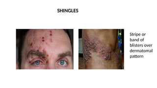 Common Rashes in emergency department.pptx