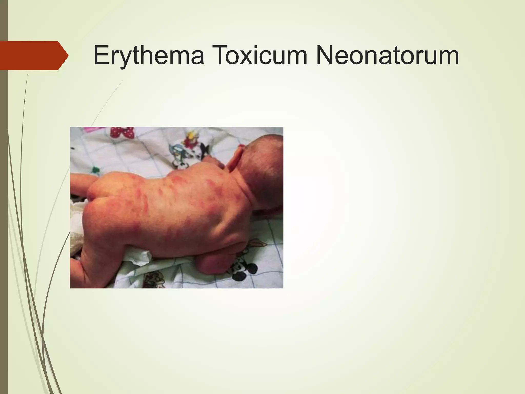 Rashes in infants and children | PPTX