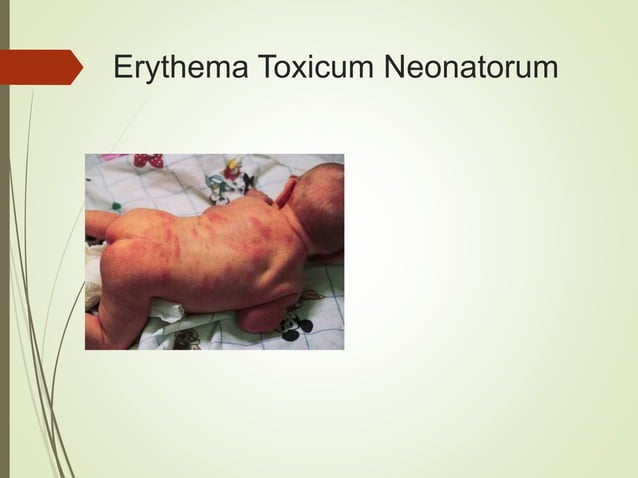 Rashes in infants and children | PPTX | Infectious Diseases | Diseases ...
