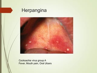 Rashes in infants and children | PPTX