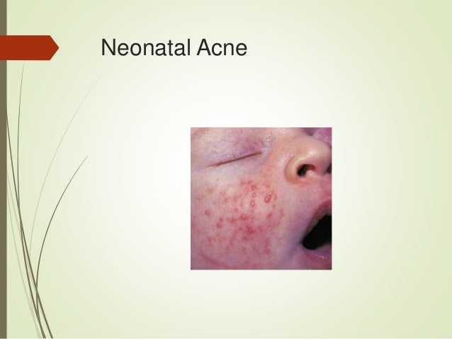 Rashes in infants and children