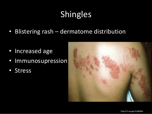 What's Rash is that!