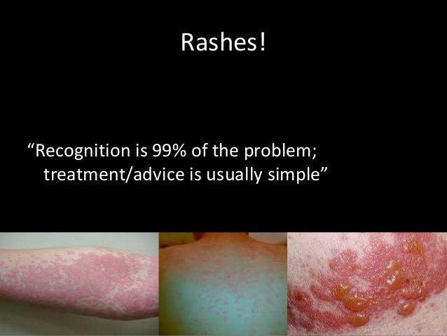 What's Rash is that!
