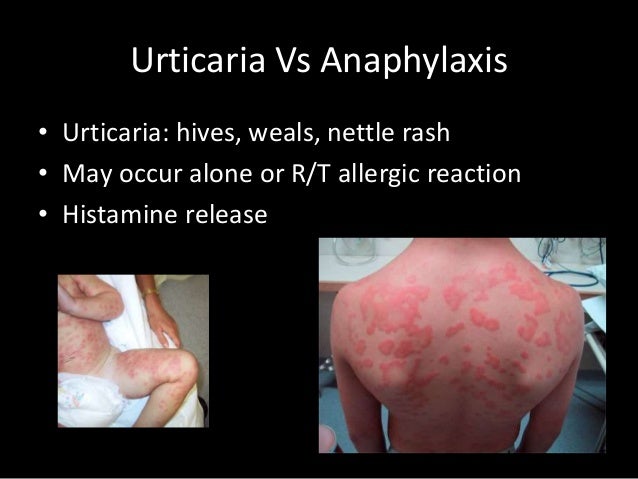 What's Rash is that!