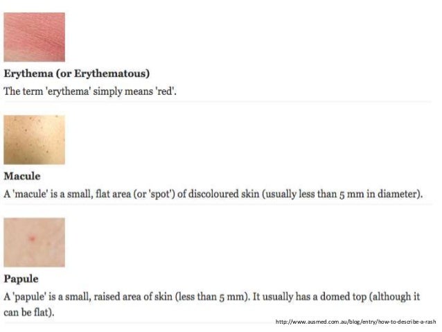 What's Rash is that!