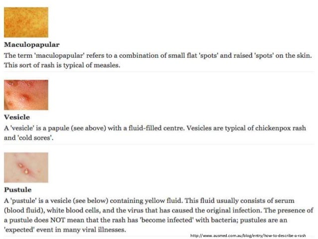 What's Rash is that!