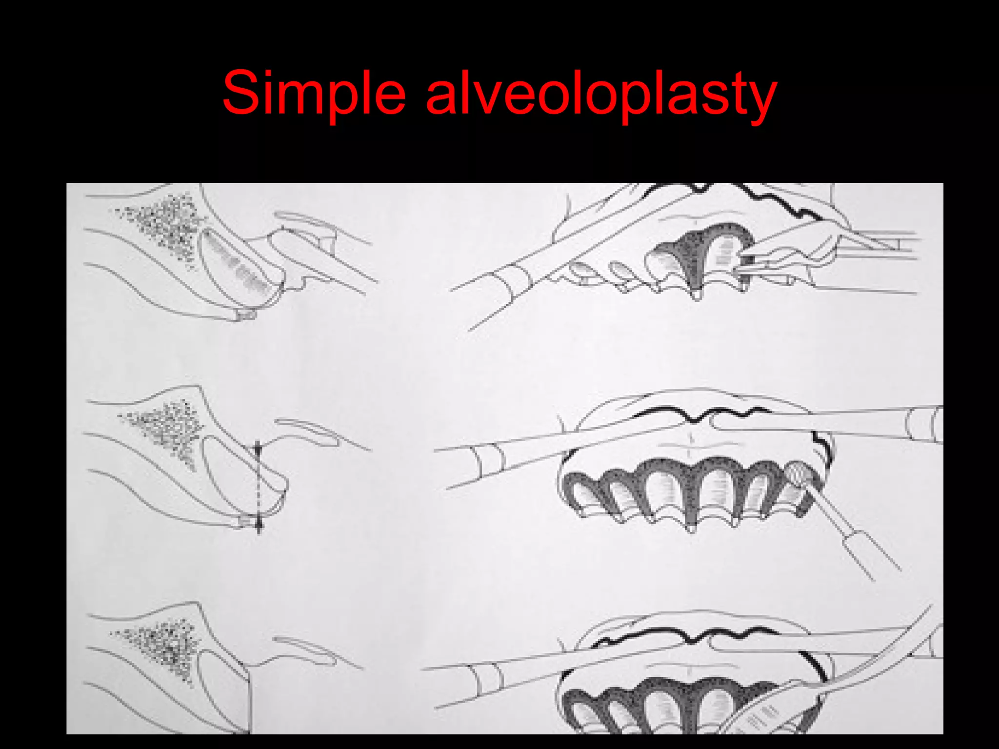 pre prosthetic mouth preparation | PPT