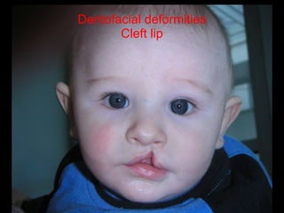 pre prosthetic mouth preparation | PPT