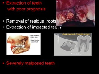 pre prosthetic mouth preparation | PPT