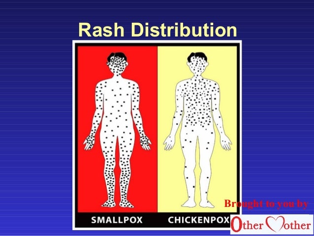 Rash illness evaluation