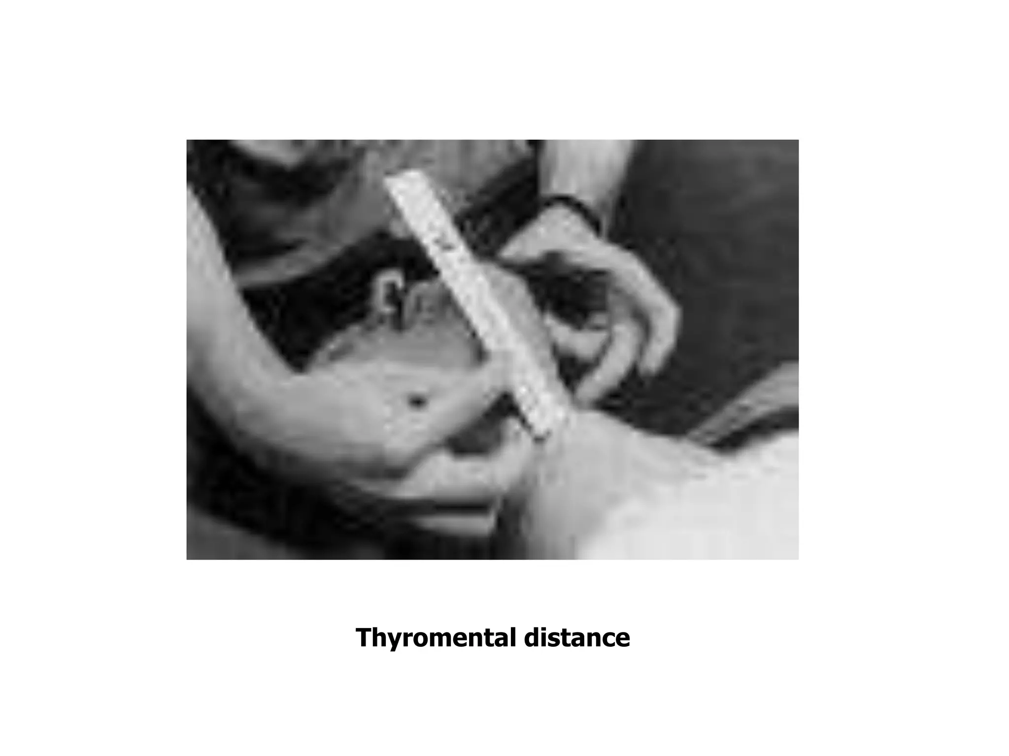 Pre-Anesthetic Checkup | PPTX