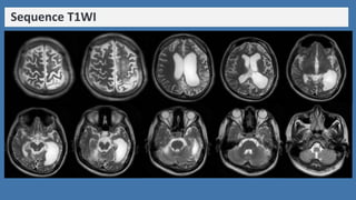 Rasmussen Encephalitis.pptx
