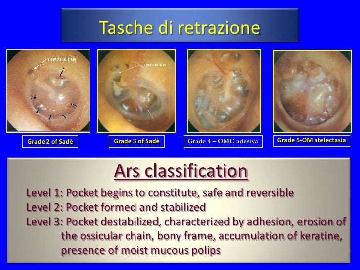 Indicazioni alla miringoplastica