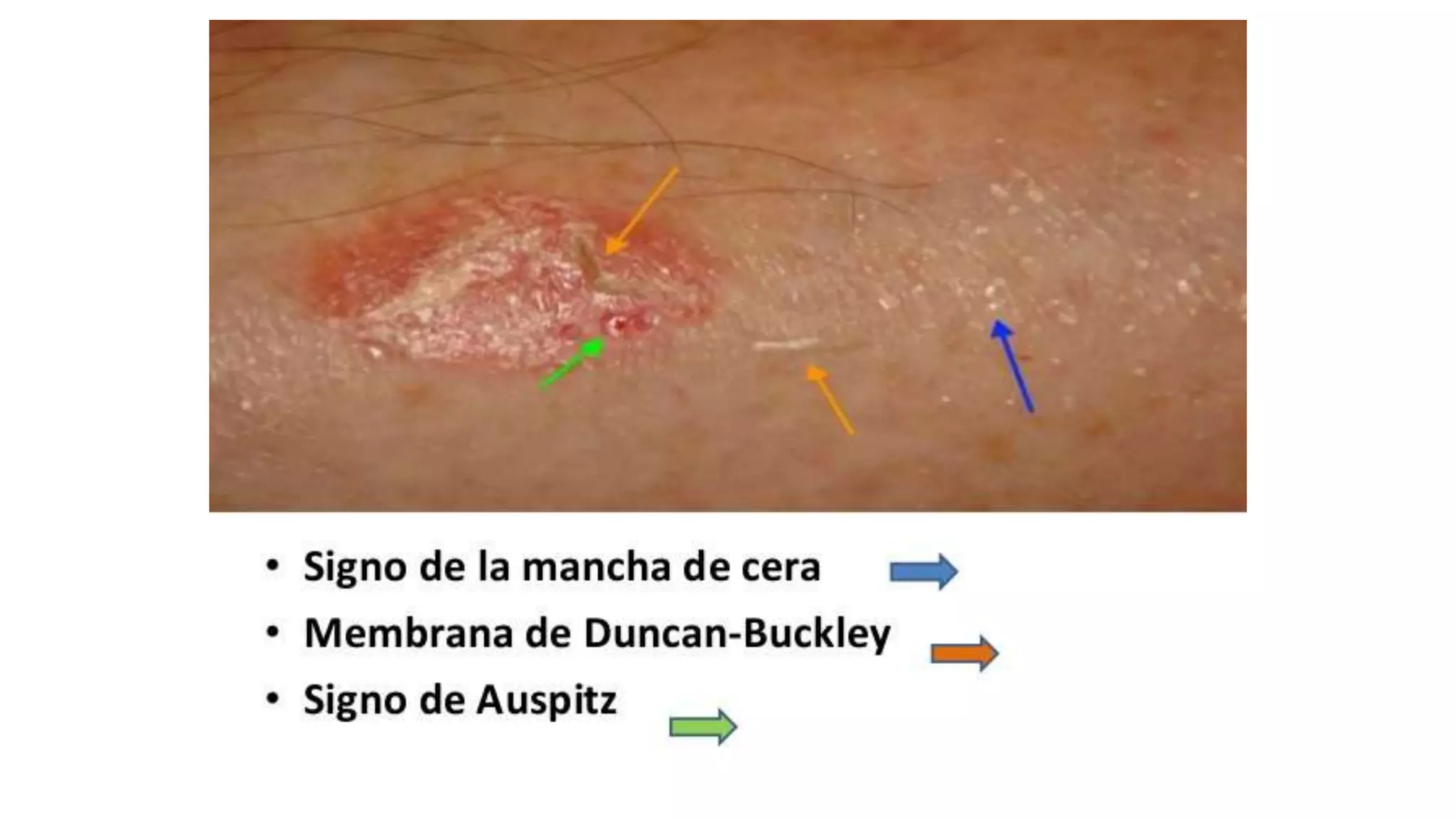 Raspado metodico de brocq signo de auspitz | PPTX
