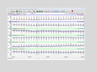 Recording of Rat ECG, BP and heart rate | PPTX