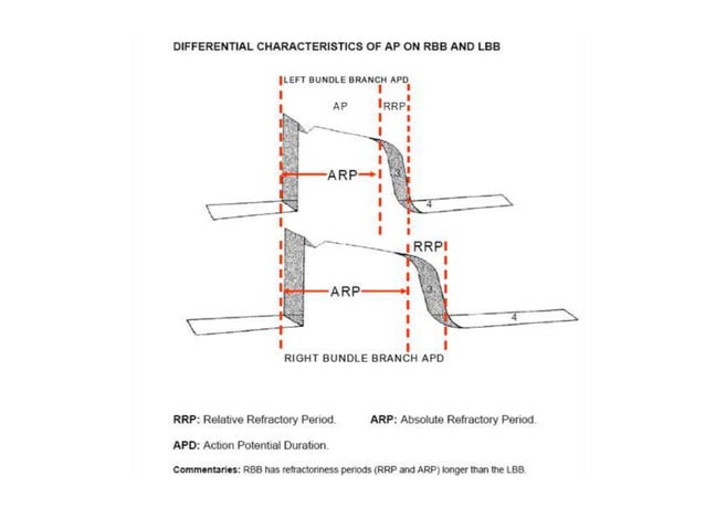 Rate dependent Bundle Branch Block | PPTX | Heart and Cardiovascular ...