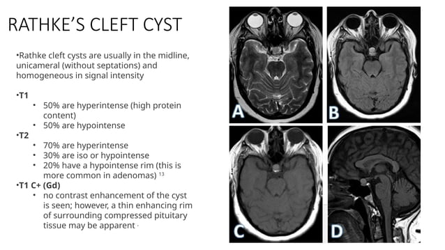 RATHKE’S CLEFT CYST QUESTION NEUROLOGY AND NEUROSURGERY | PPTX