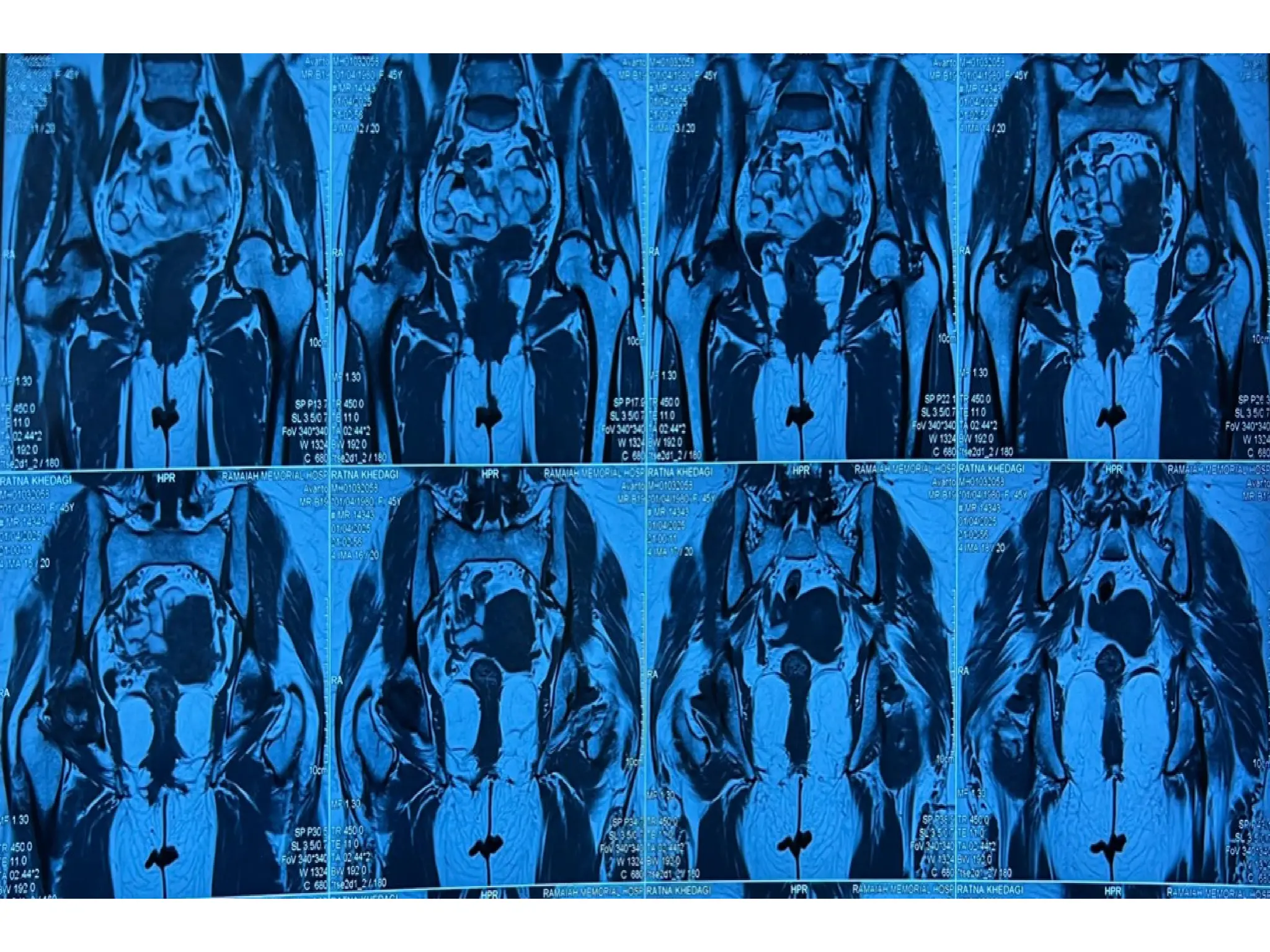 MRI and X rays of oa hip with ankylosing spondylitis.pptx