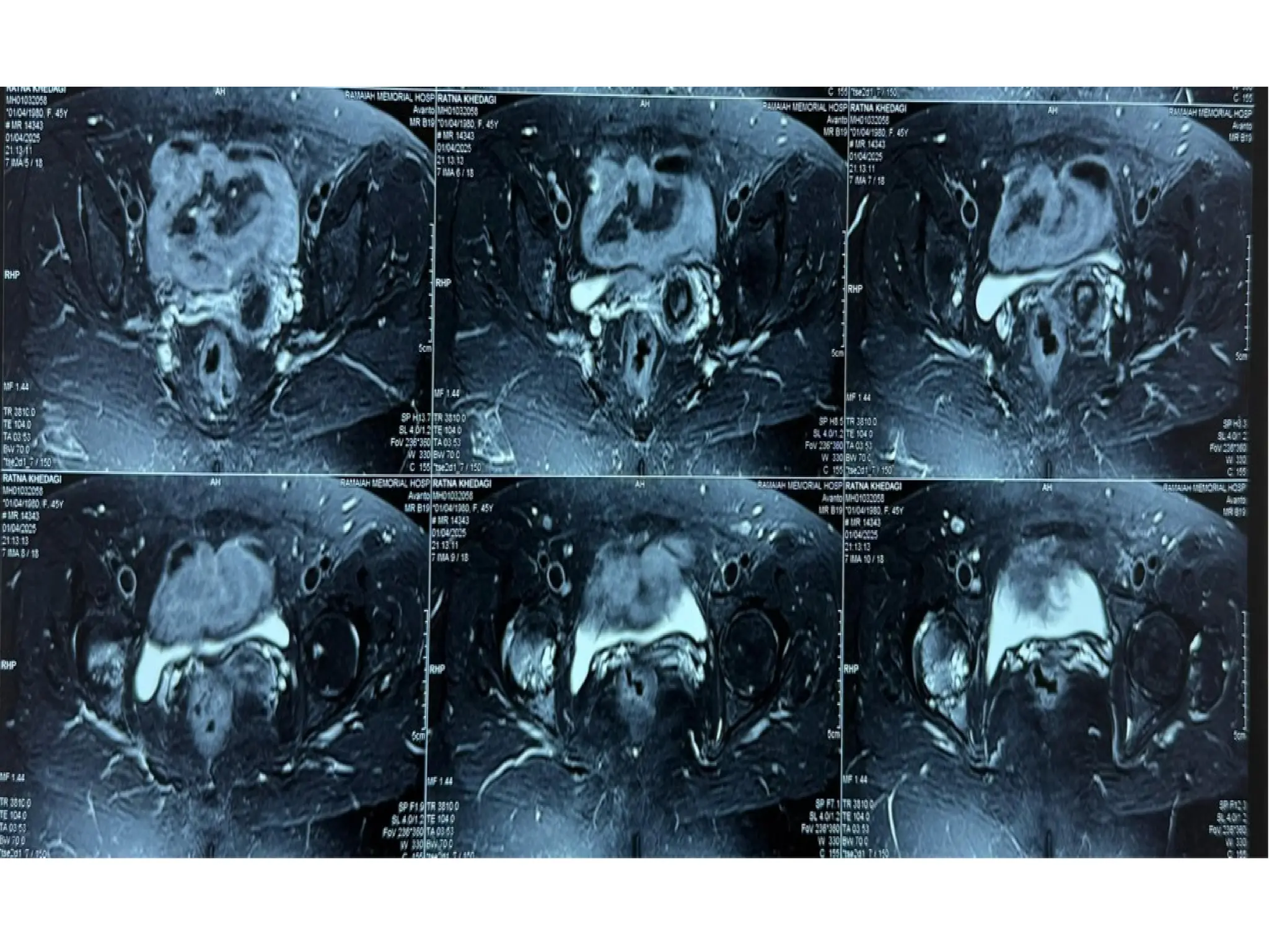 MRI and X rays of oa hip with ankylosing spondylitis.pptx