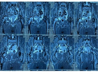 MRI and X rays of oa hip with ankylosing spondylitis.pptx