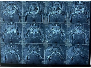 MRI and express of OA hip with ankle spondylitis.ppt