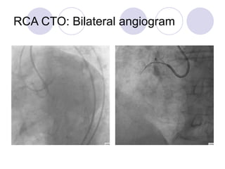 CTO and atrial fibrillation – Do we apply the ESC recommendations? | PPT