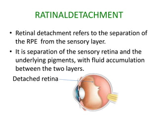 Retinal detachment | PPTX