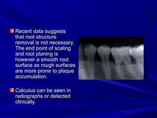 Rationale for scaling and root planing | PPT