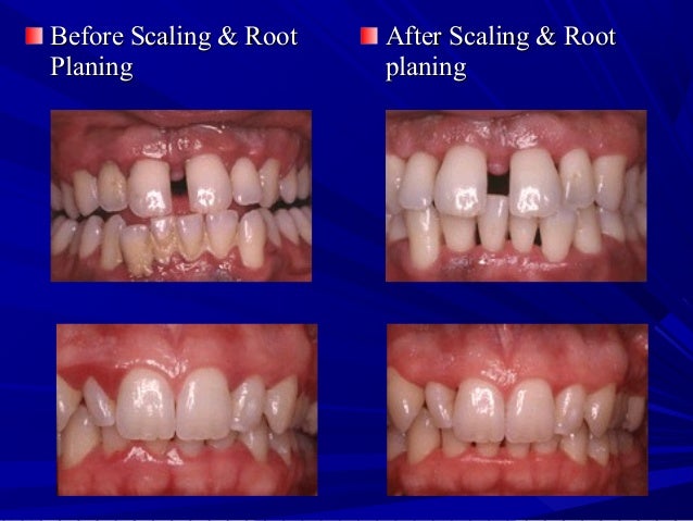 Rationale for scaling and root planing