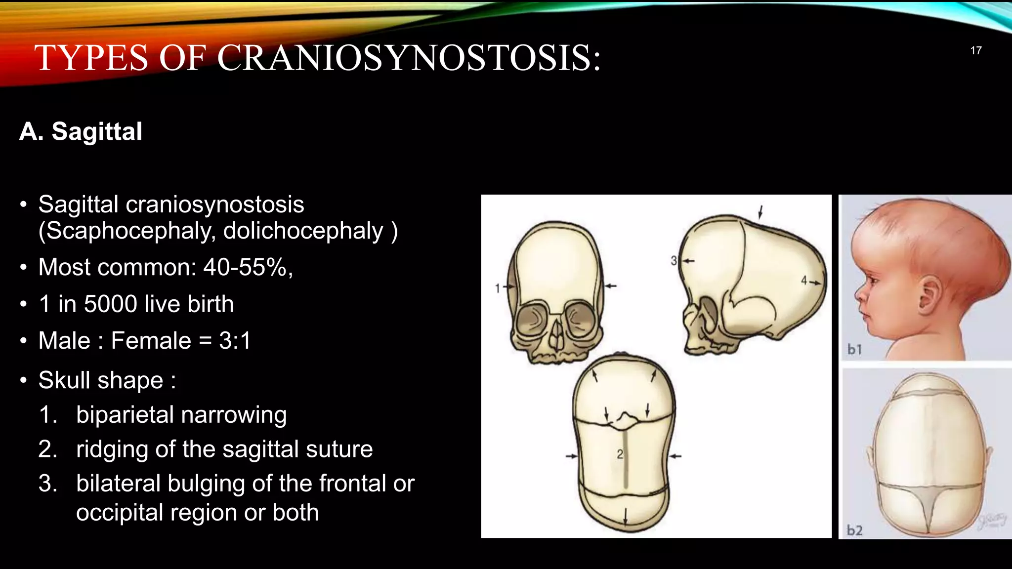 Anesthesia management of Craniosynostosis | PPTX