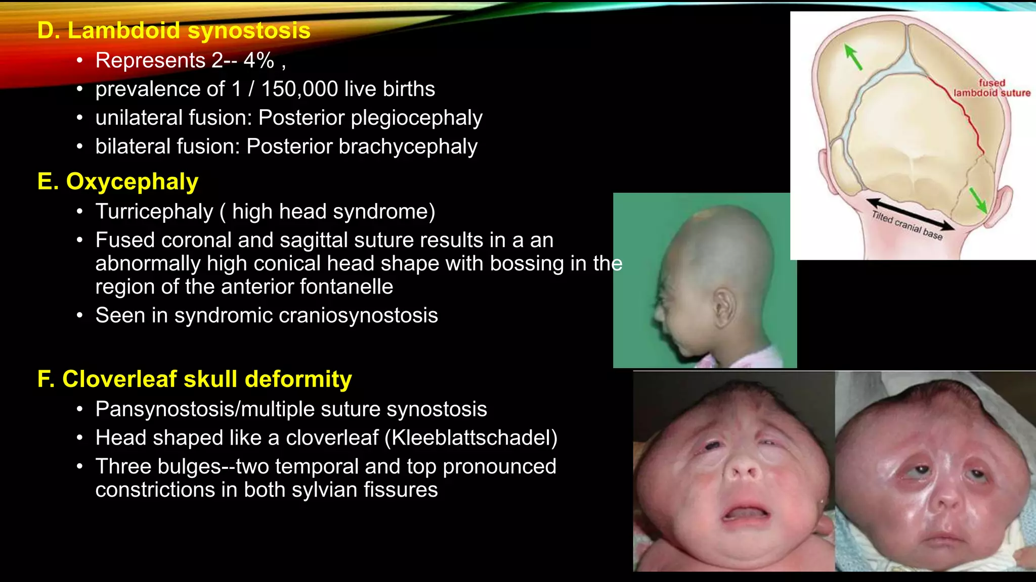 Anesthesia management of Craniosynostosis | PPTX