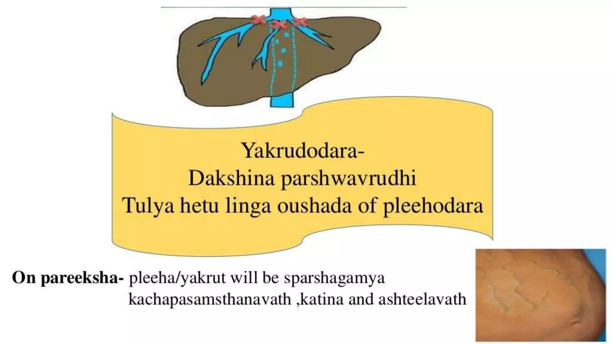 udara roga ascites | PPTX