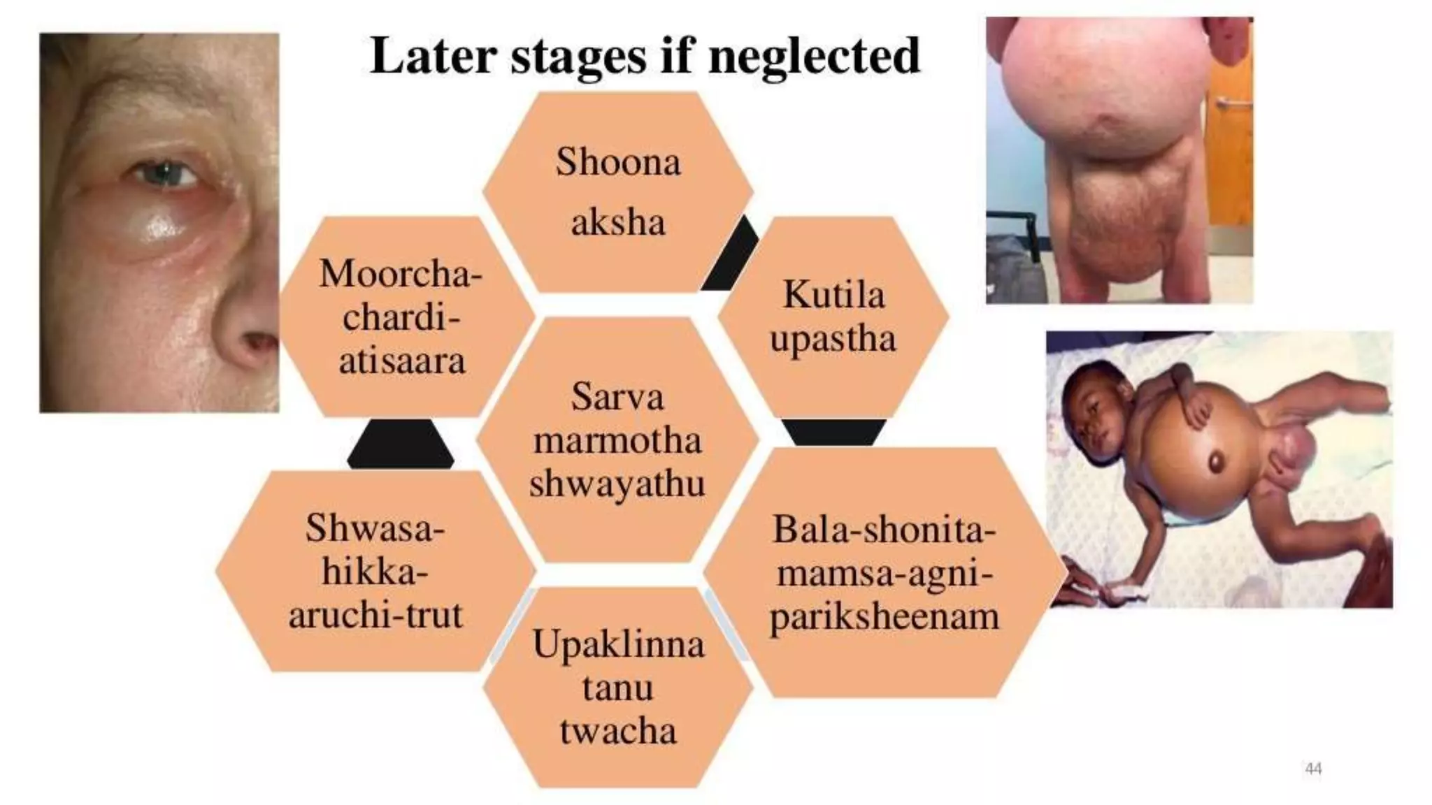 udara roga ascites | PPTX