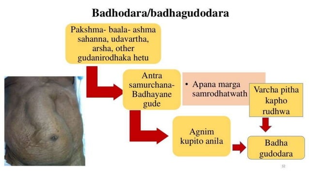 udara roga ascites | PPTX