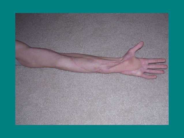 Rattlesnake bite | PPT | Physical Therapy | Wellness