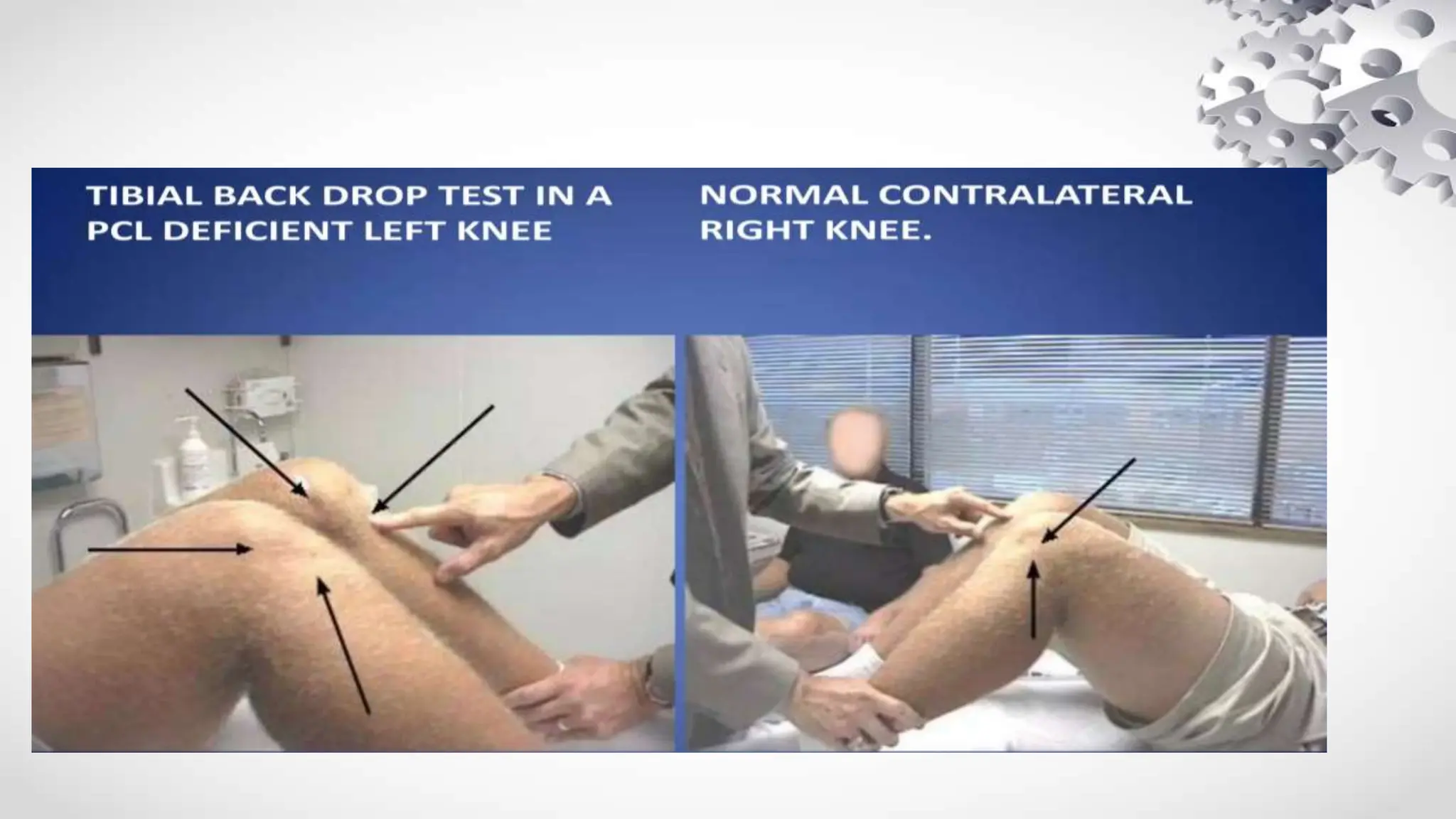 Internal_derangements_of_Knee.pptx in orthopaedics | PPTX