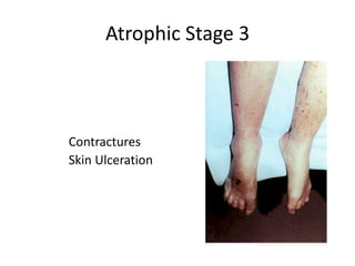 complex regional pain syndrome. C.R.P.S | PPTX